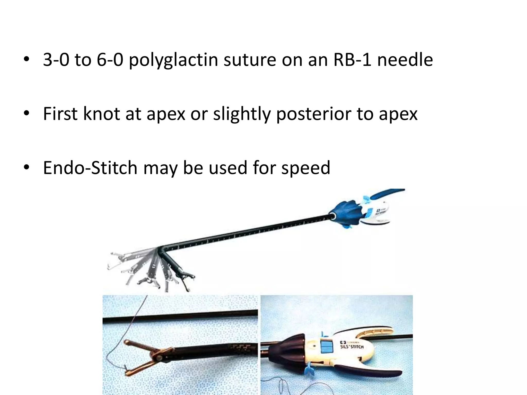 Pelviureteral Junction Obstruction (PUJO) - Laparoscopic and robotic ...