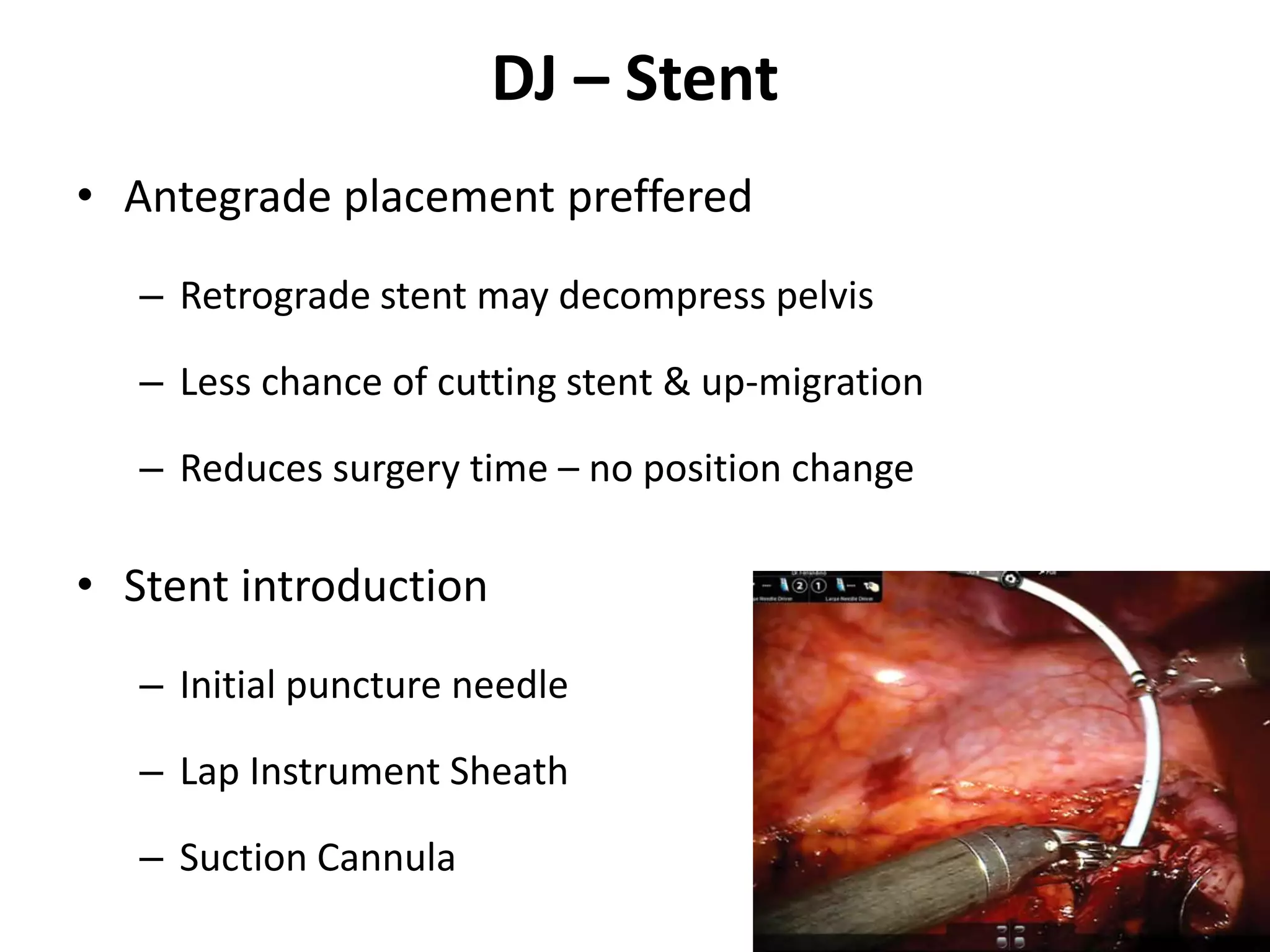 Pelviureteral Junction Obstruction (PUJO) - Laparoscopic and robotic ...