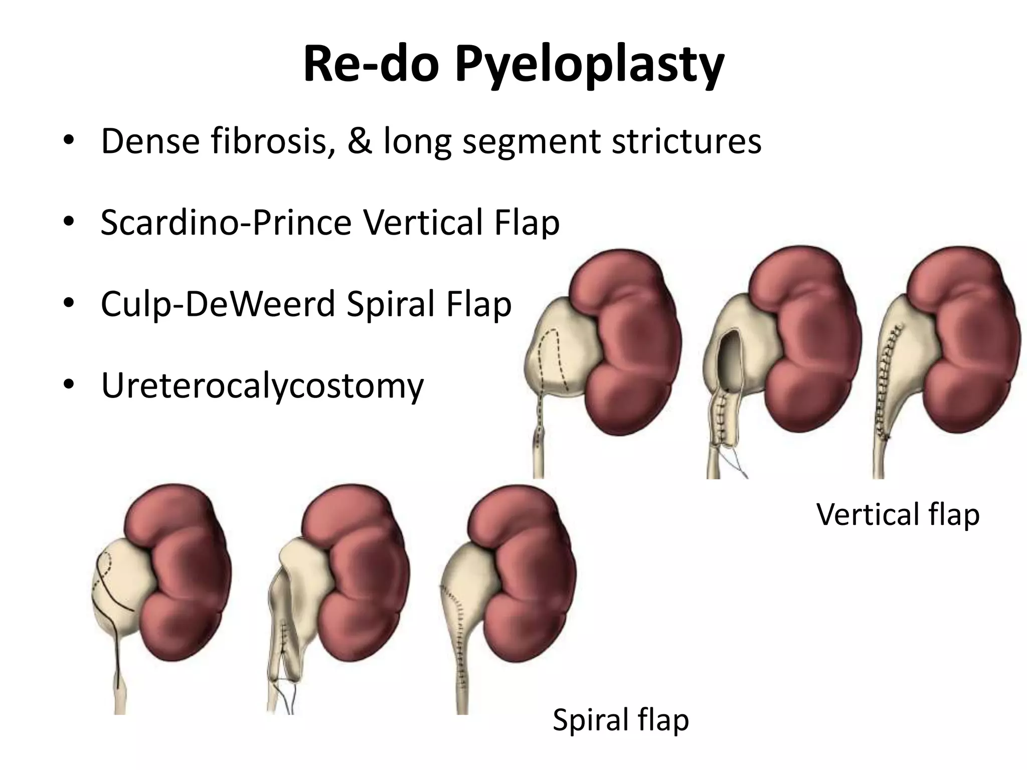 Pelviureteral Junction Obstruction (PUJO) - Laparoscopic and robotic ...