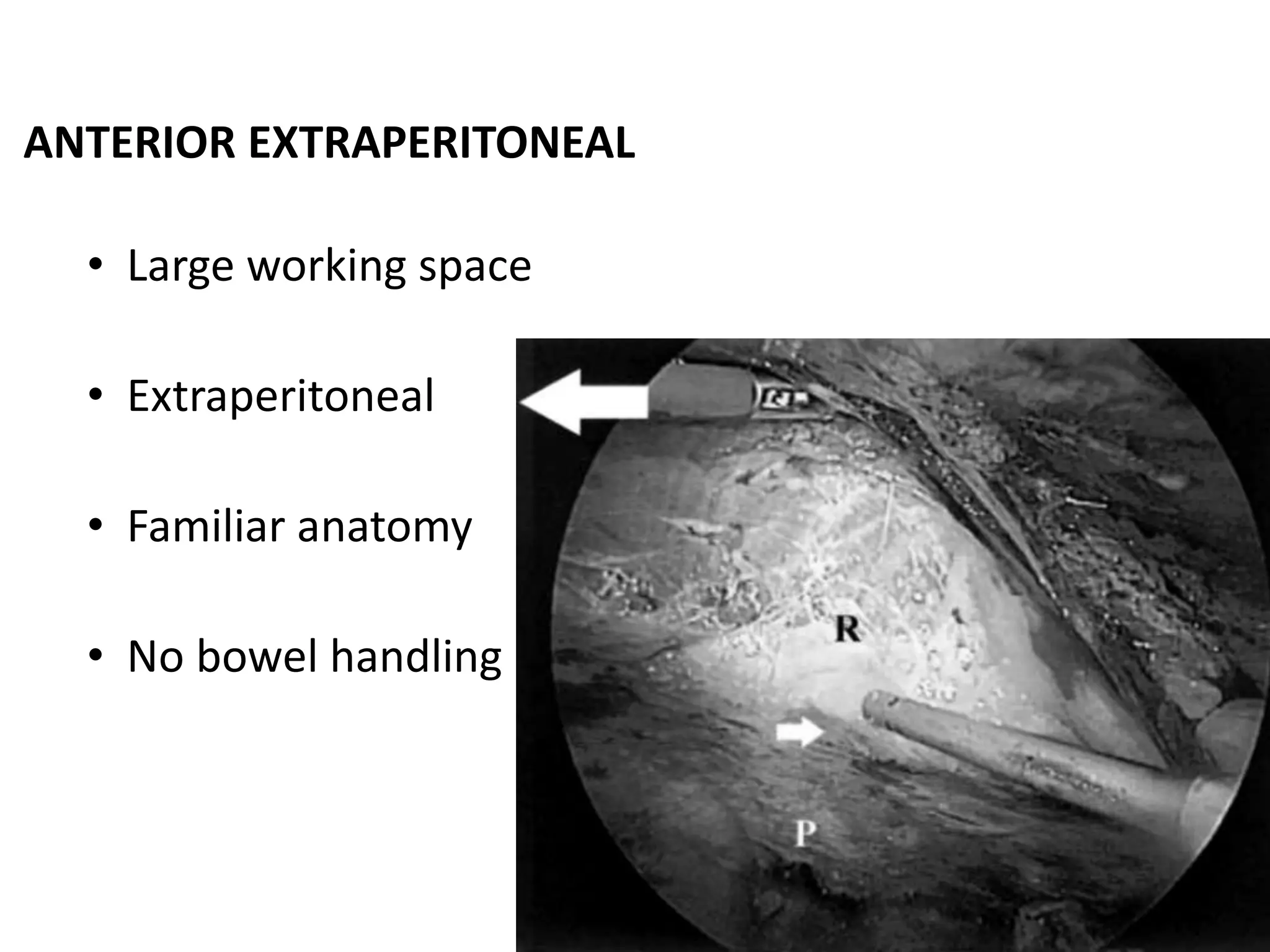 Pelviureteral Junction Obstruction (PUJO) - Laparoscopic and robotic ...