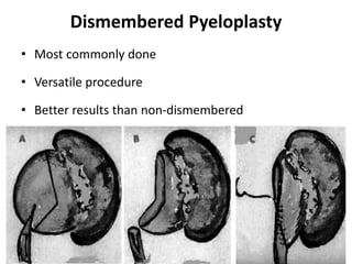 Pelviureteral Junction Obstruction (PUJO) - Laparoscopic and robotic ...