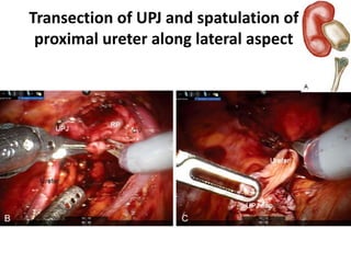 Pelviureteral Junction Obstruction (PUJO) - Laparoscopic and robotic ...