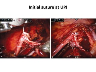 Pelviureteral Junction Obstruction (PUJO) - Laparoscopic and robotic ...