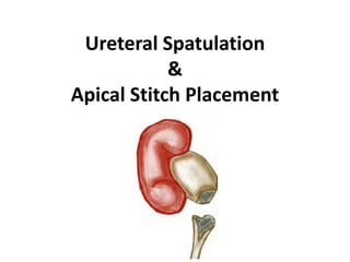 Pelviureteral Junction Obstruction (PUJO) - Laparoscopic and robotic ...