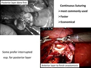 Pelviureteral Junction Obstruction (PUJO) - Laparoscopic and robotic ...