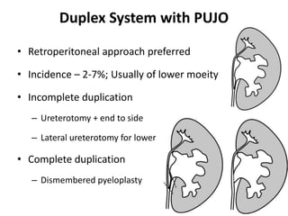 Pelviureteral Junction Obstruction (PUJO) - Laparoscopic and robotic ...