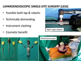 Pelviureteral Junction Obstruction (PUJO) - Laparoscopic and robotic ...