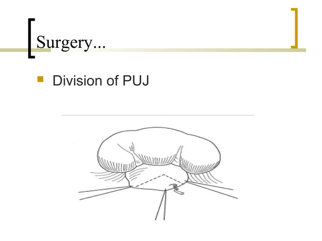 Puj obstruction | PPT