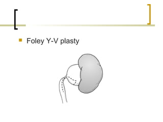 Puj obstruction | PPT