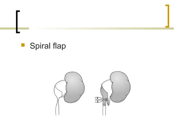 Puj obstruction | PPT