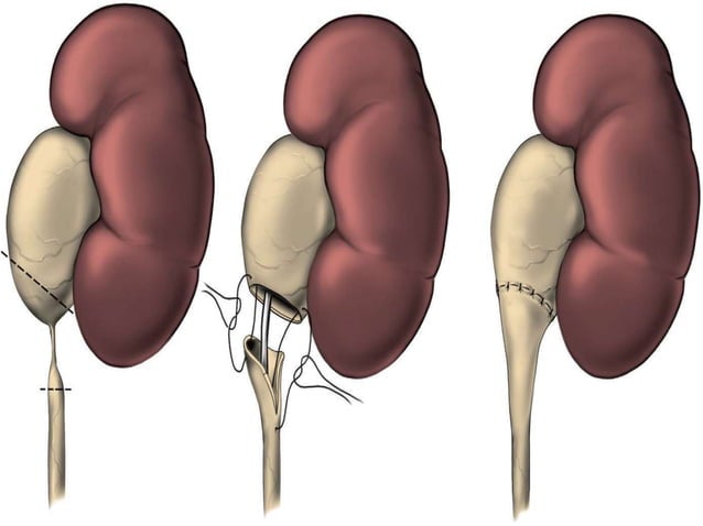 Puj obstruction | PPTX