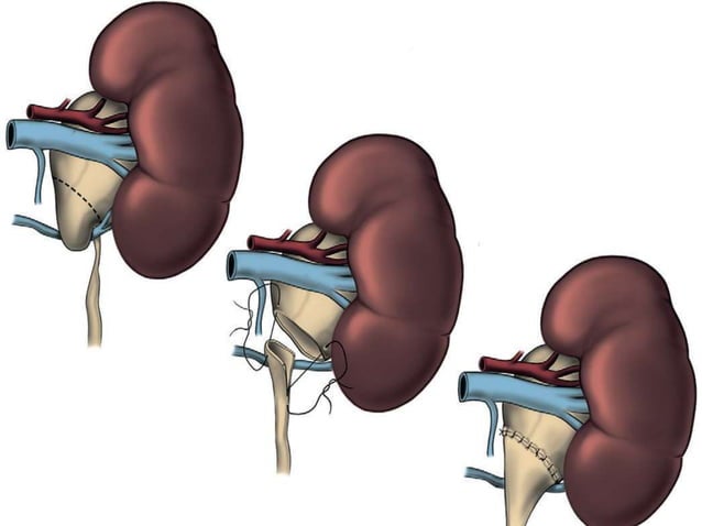 Puj obstruction | PPTX