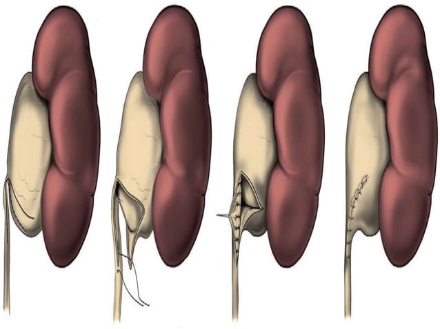 Puj obstruction | PPTX