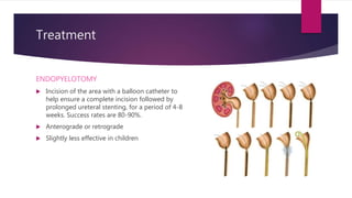 PUJ obstruction.pptx | Pregnancy | Reproductive Health