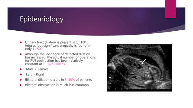PUJ obstruction.pptx | Pregnancy | Reproductive Health