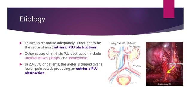 PUJ obstruction.pptx | Pregnancy | Reproductive Health