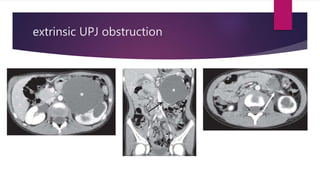 PUJ obstruction.pptx | Pregnancy | Reproductive Health