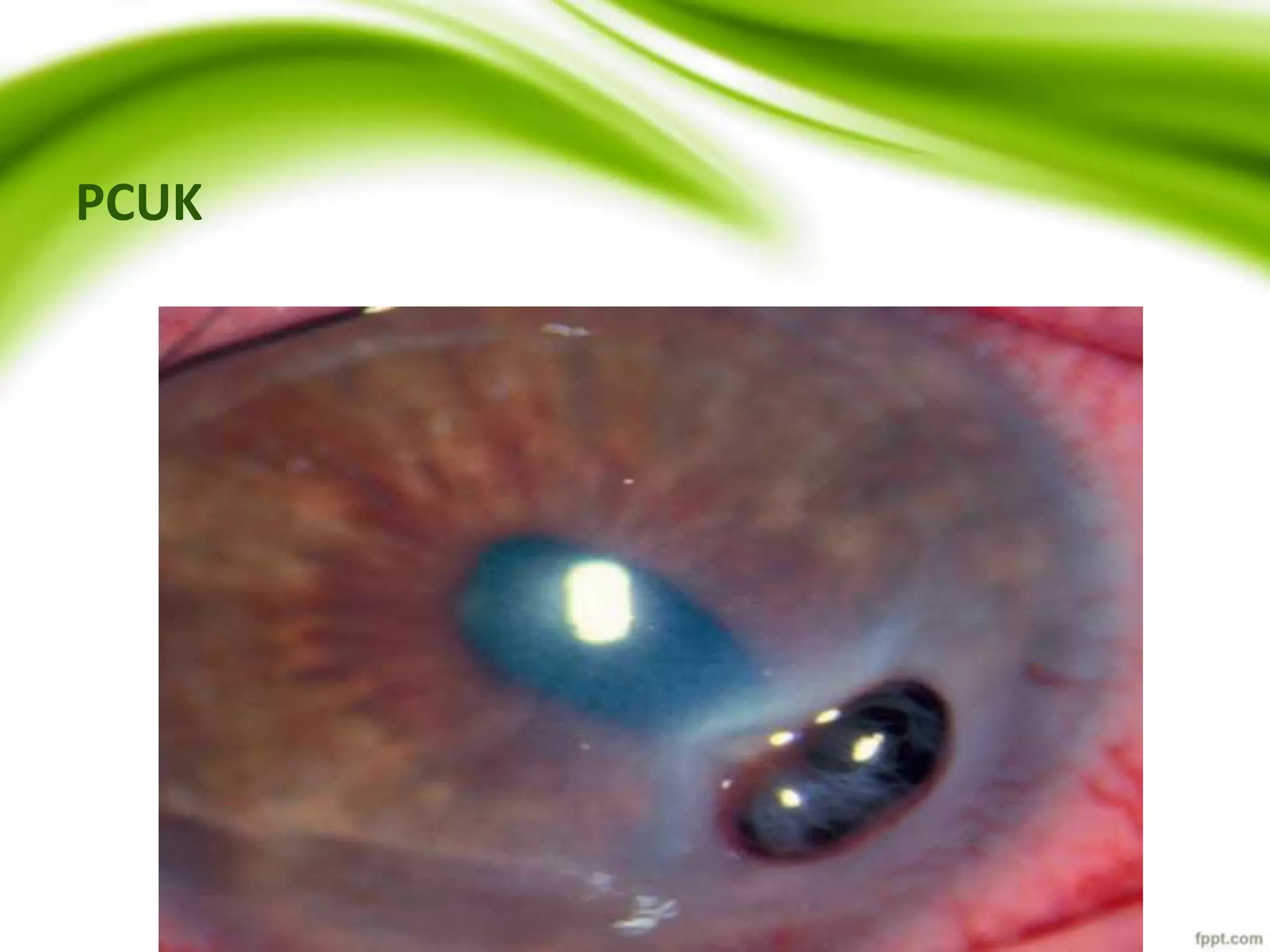 Peripheral Ulcerative Keratitis.Dr Ferdous | PPTX