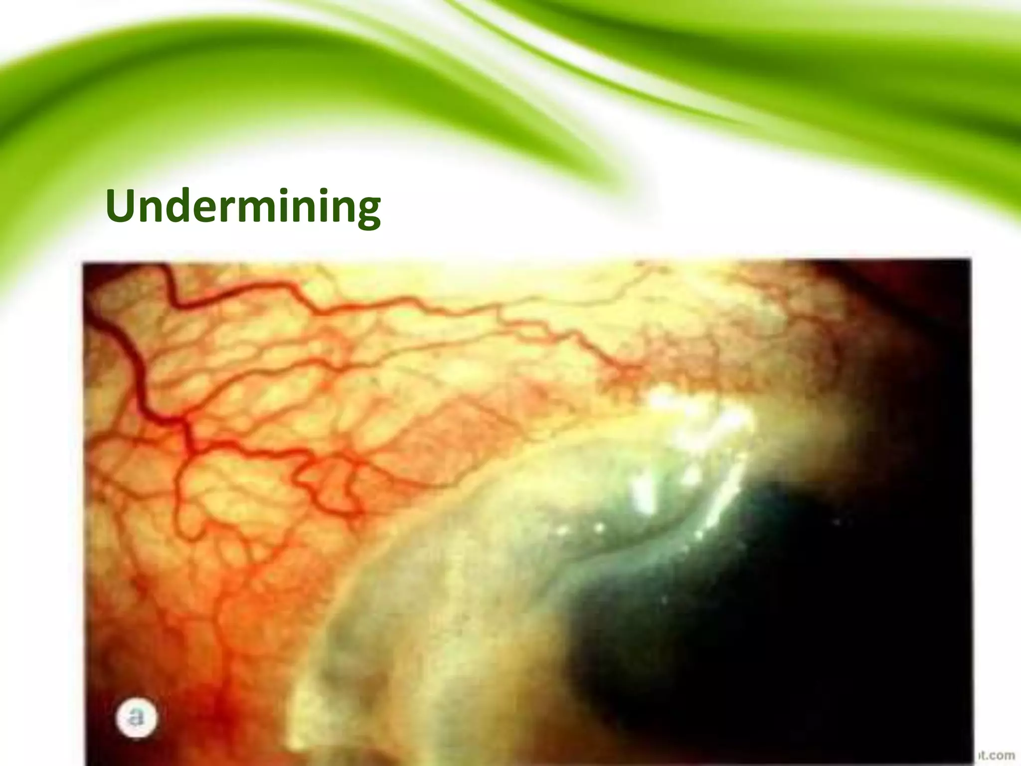 Peripheral Ulcerative Keratitis.Dr Ferdous | PPTX