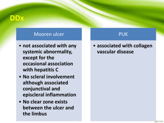 Peripheral Ulcerative Keratitis.Dr Ferdous | PPTX