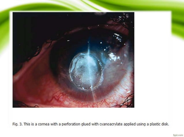 Peripheral Ulcerative Keratitis.Dr Ferdous | PPT