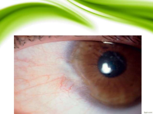 Peripheral Ulcerative Keratitis.Dr Ferdous | PPT