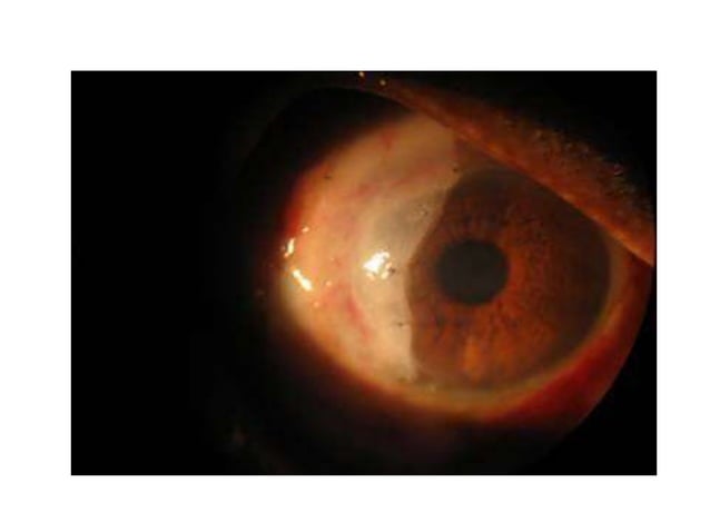 PERIPHERAL ULCERATIVE KERATITIS | PPTX | Eye and Vision Conditions ...