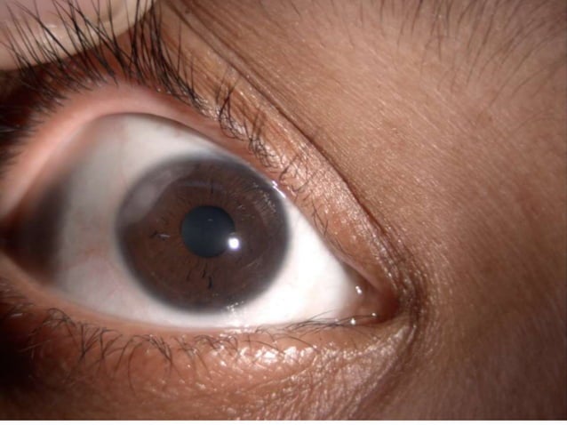 PERIPHERAL ULCERATIVE KERATITIS | PPTX | Eye and Vision Conditions ...