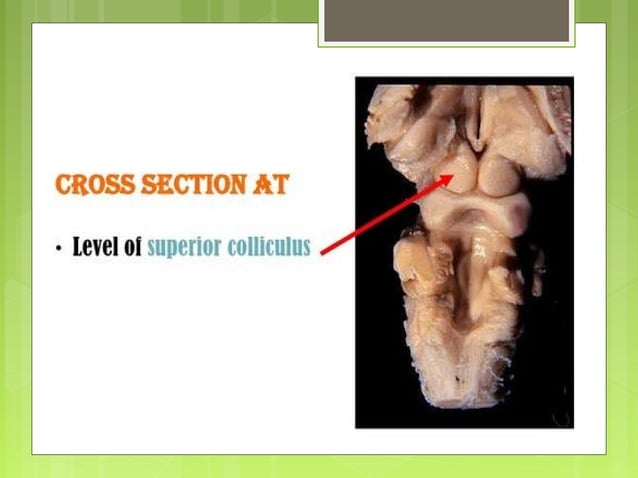 MIDBRAIN basic anatomy and applied aspects. | PPT