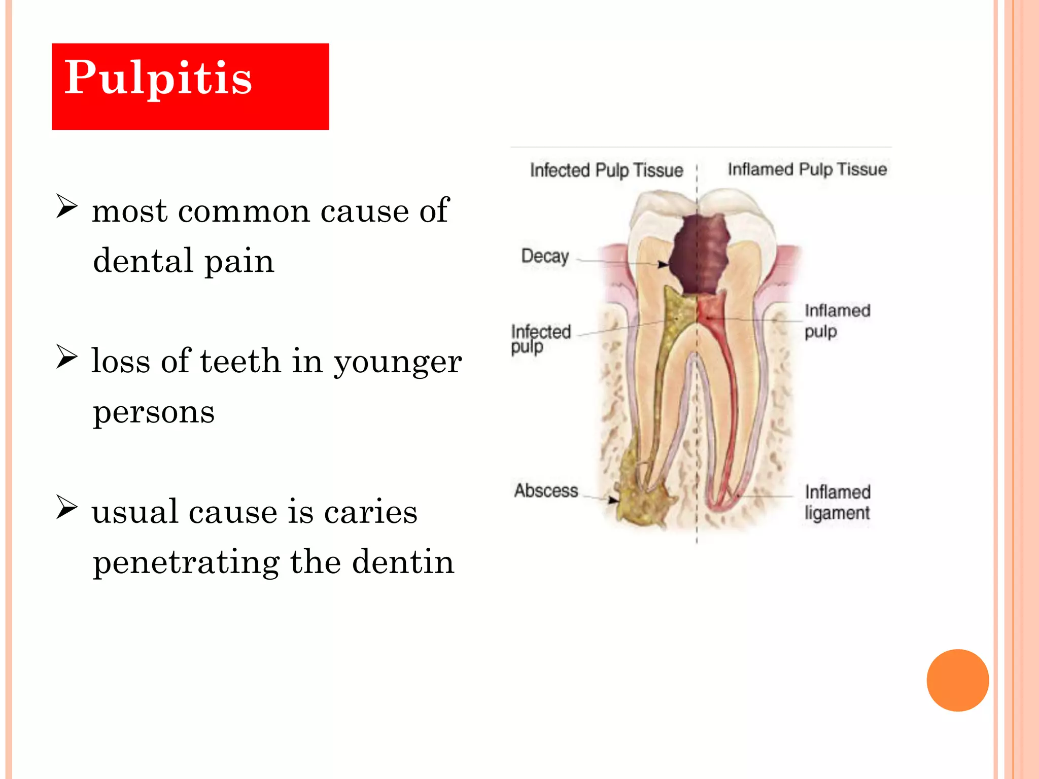 Pulipitis | PPT