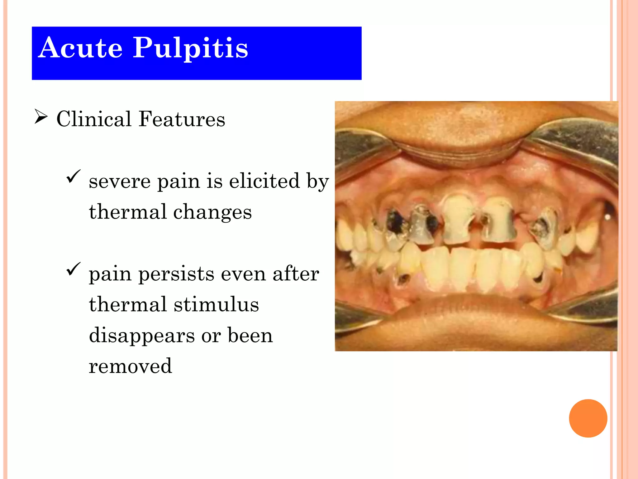 Pulipitis | PPT