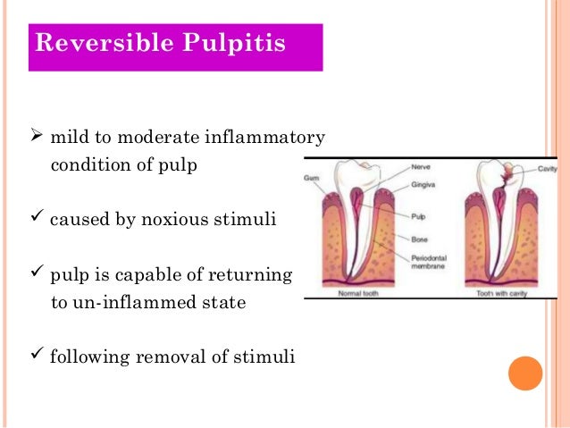 Reversible Pulpitis