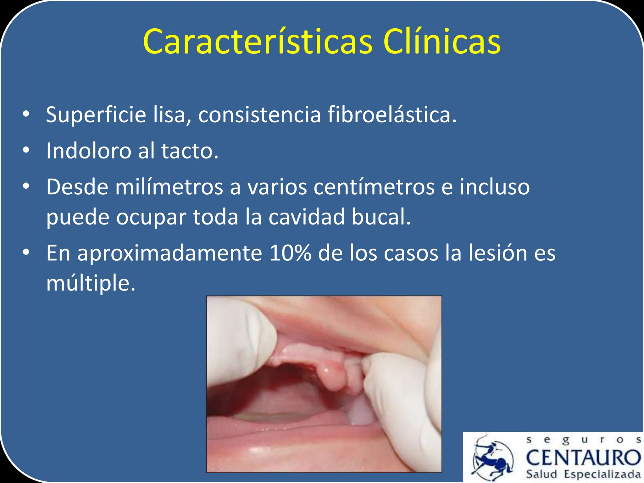 Épulis_Congenito_generalidades y caracteristicasppsx | PPSX