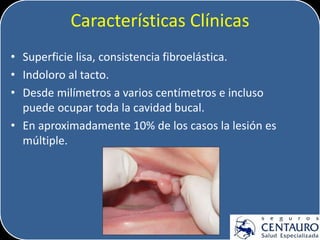 Épulis_Congenito_generalidades y caracteristicasppsx | PPSX