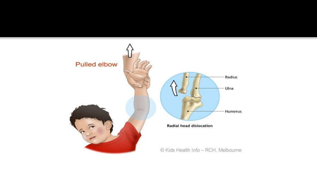 Pulled elbow | PPTX | Death, Injury, or Military Conflict | Sensitive ...