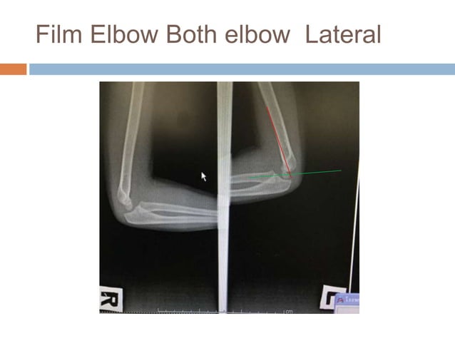 Pull elbow | PPT
