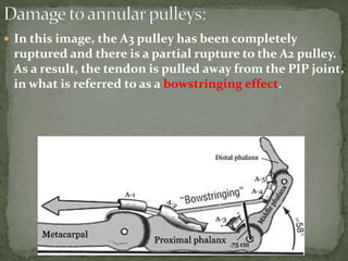 PULLEYS OF HAND. PPT..pptx