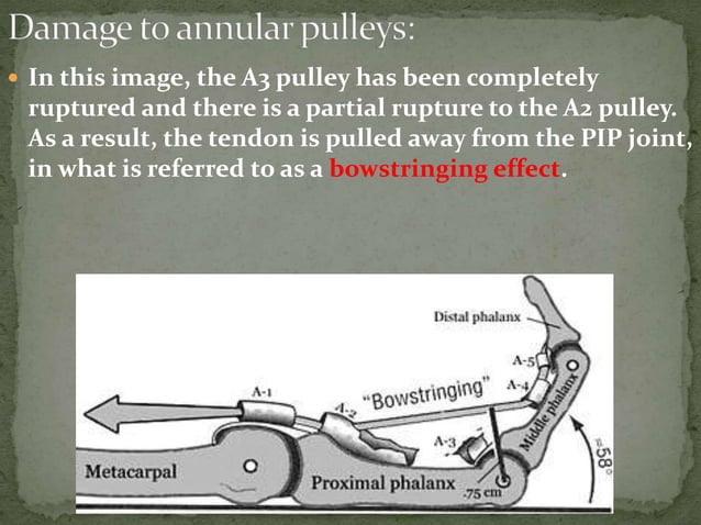 PULLEYS OF HAND. PPT..pptx