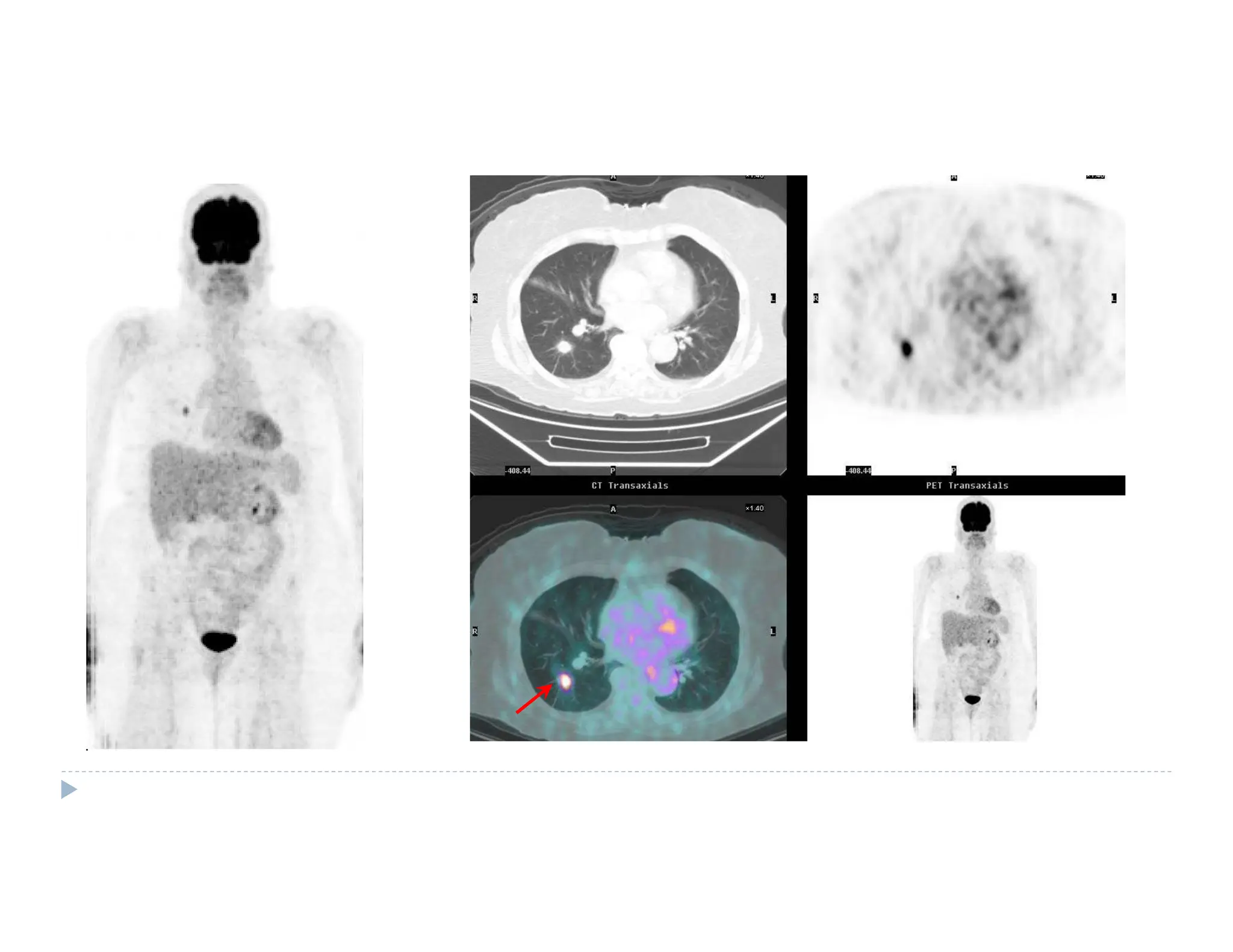 Pulmologija, dijasnosticje metode nuklearne medicine | PDF