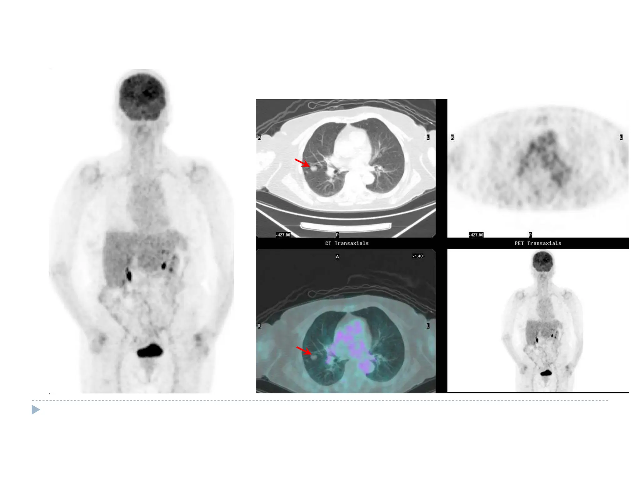 Pulmologija, dijasnosticje metode nuklearne medicine | PDF