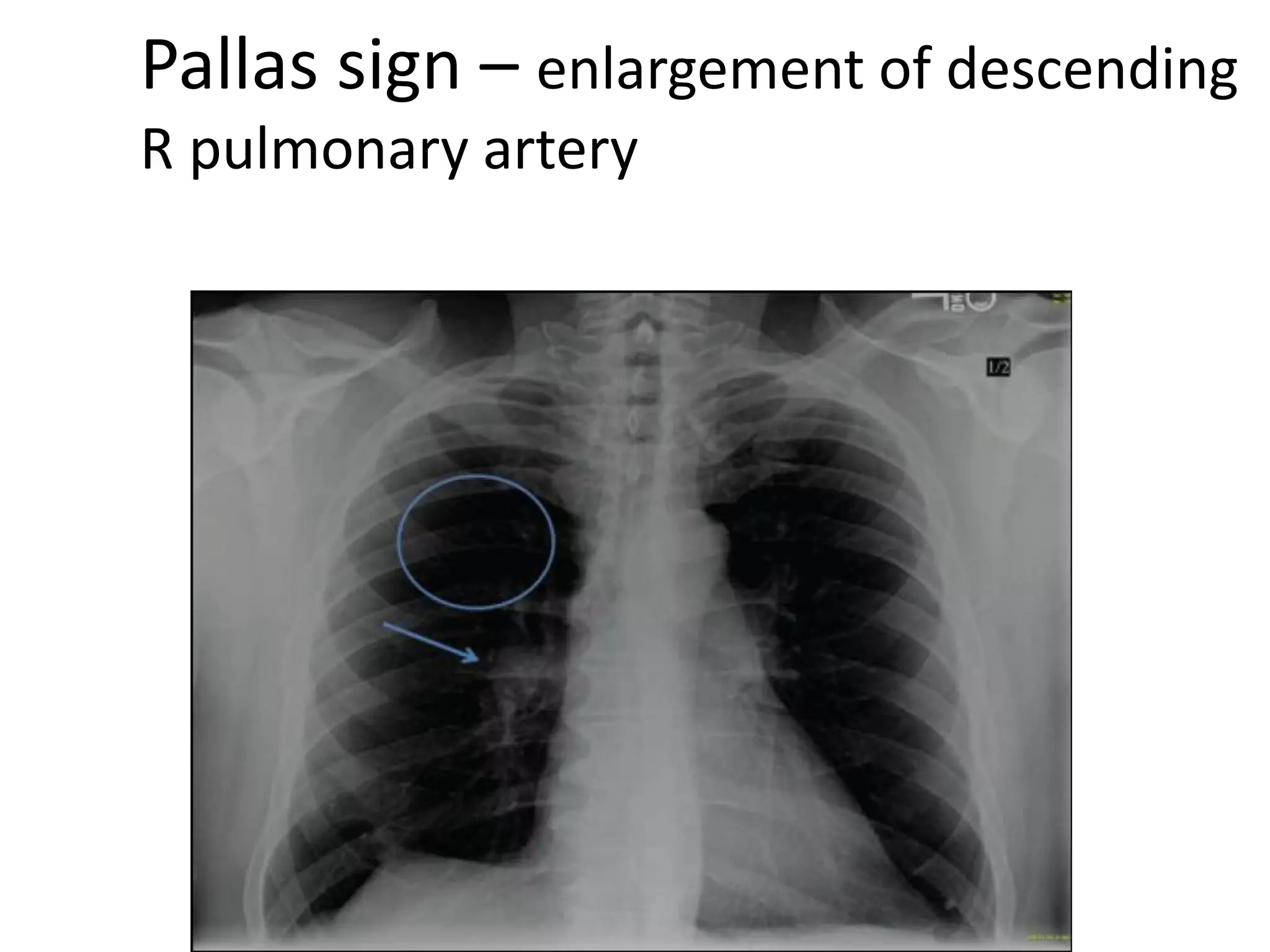 Pulmonary embolism | PPTX
