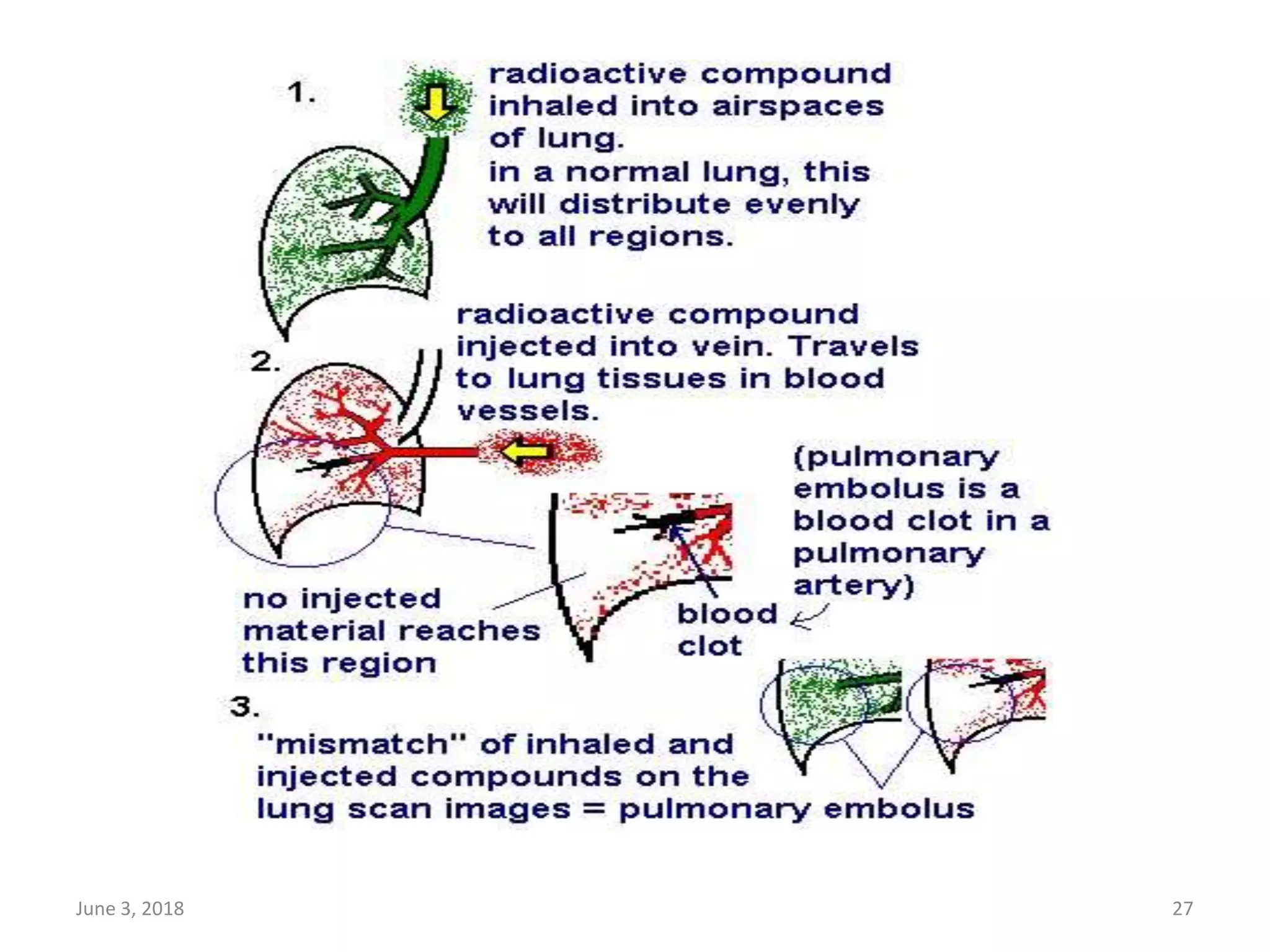 Pulmonary embolism | PPTX