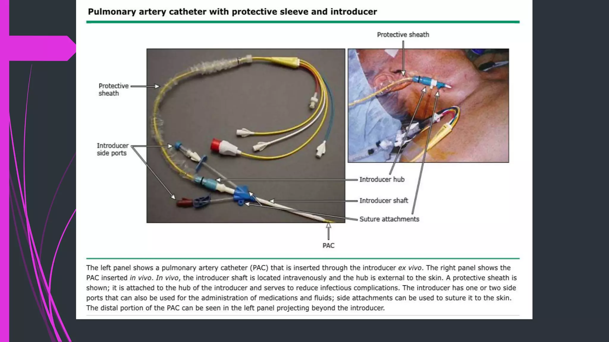 Pulmonary artery catheter | PPTX
