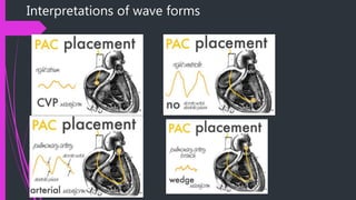 Pulmonary artery catheter | PPTX