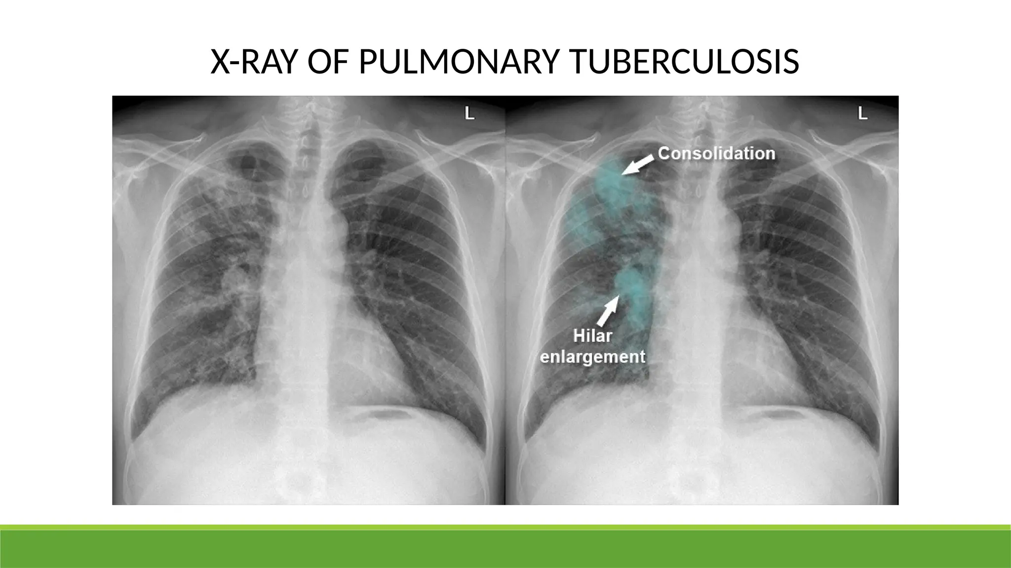 Pulmonary Tuberculosis: Comprehensive Overview of Diagnosis, Treatment, and Management | PPTX