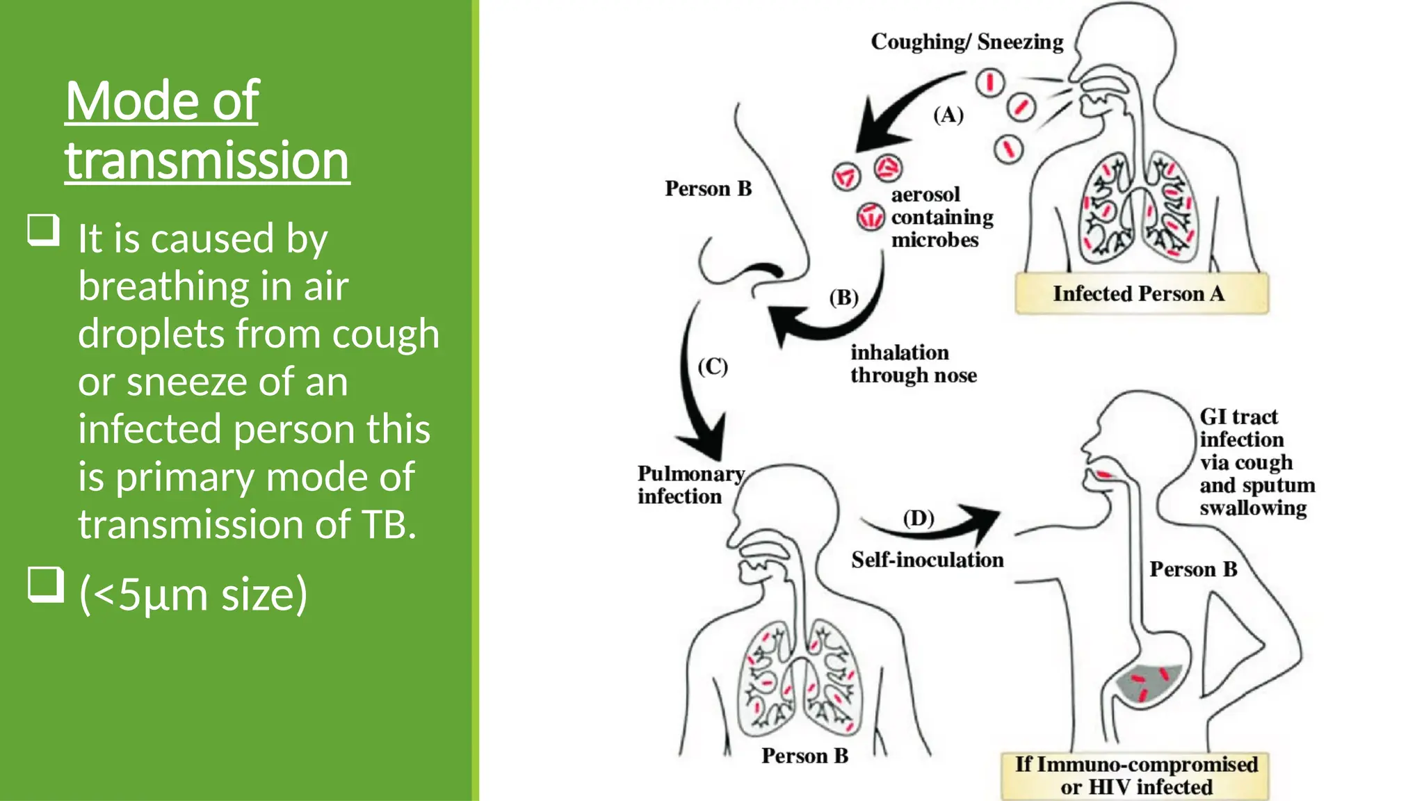 Pulmonary Tuberculosis: Comprehensive Overview of Diagnosis, Treatment ...