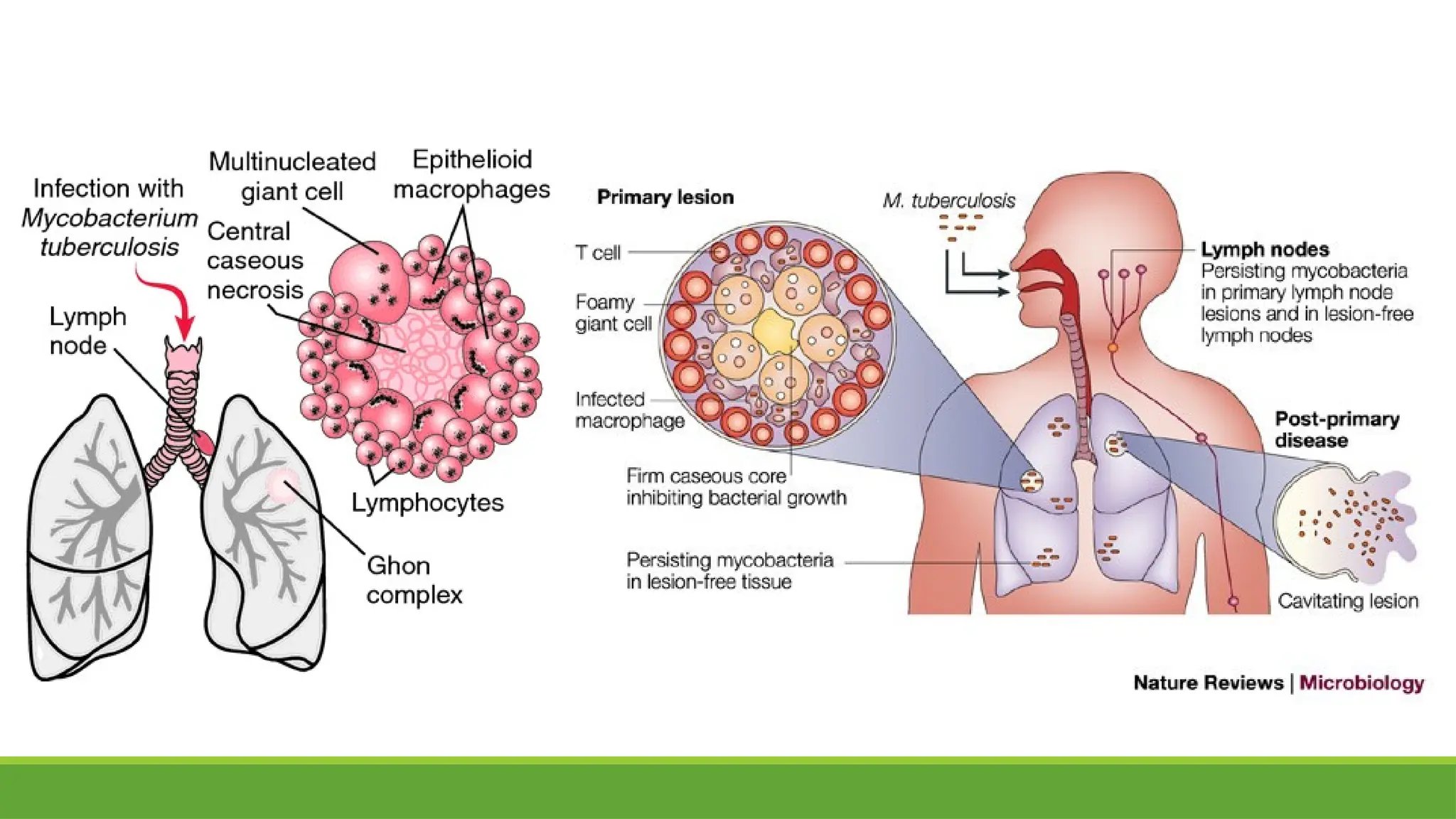 Pulmonary Tuberculosis: Comprehensive Overview of Diagnosis, Treatment ...