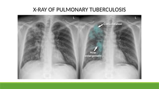 Pulmonary Tuberculosis: Comprehensive Overview of Diagnosis, Treatment ...