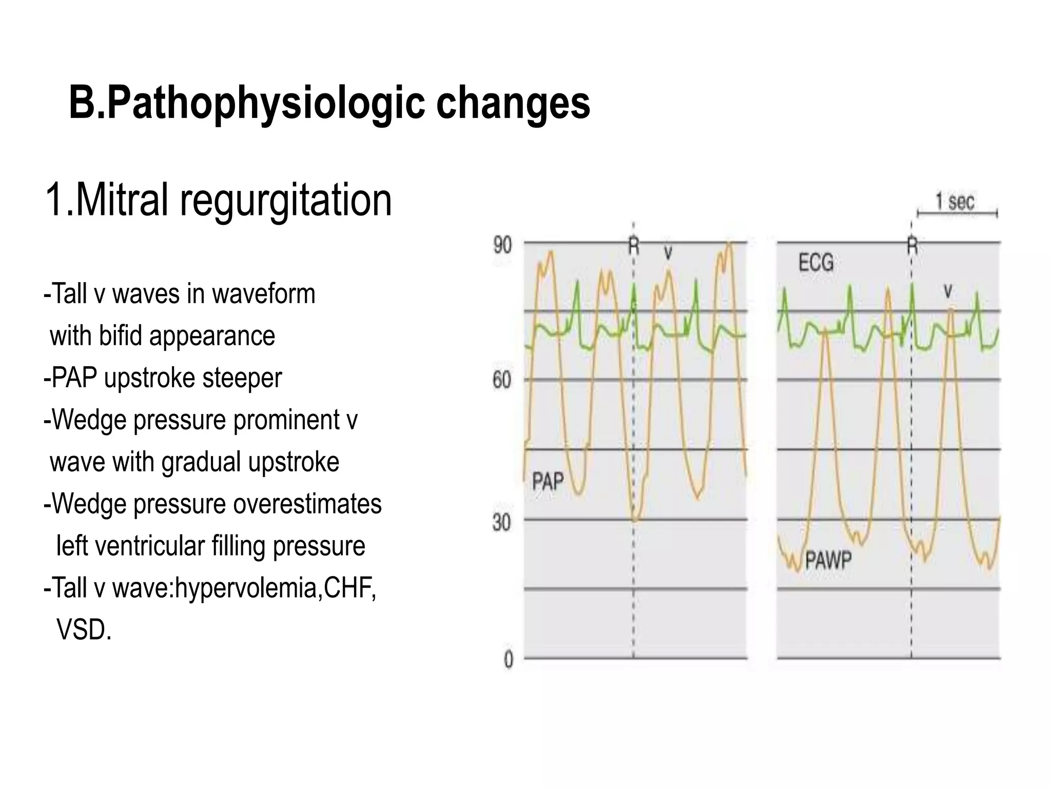 Pulmonary artery-catheter2 | PPTX