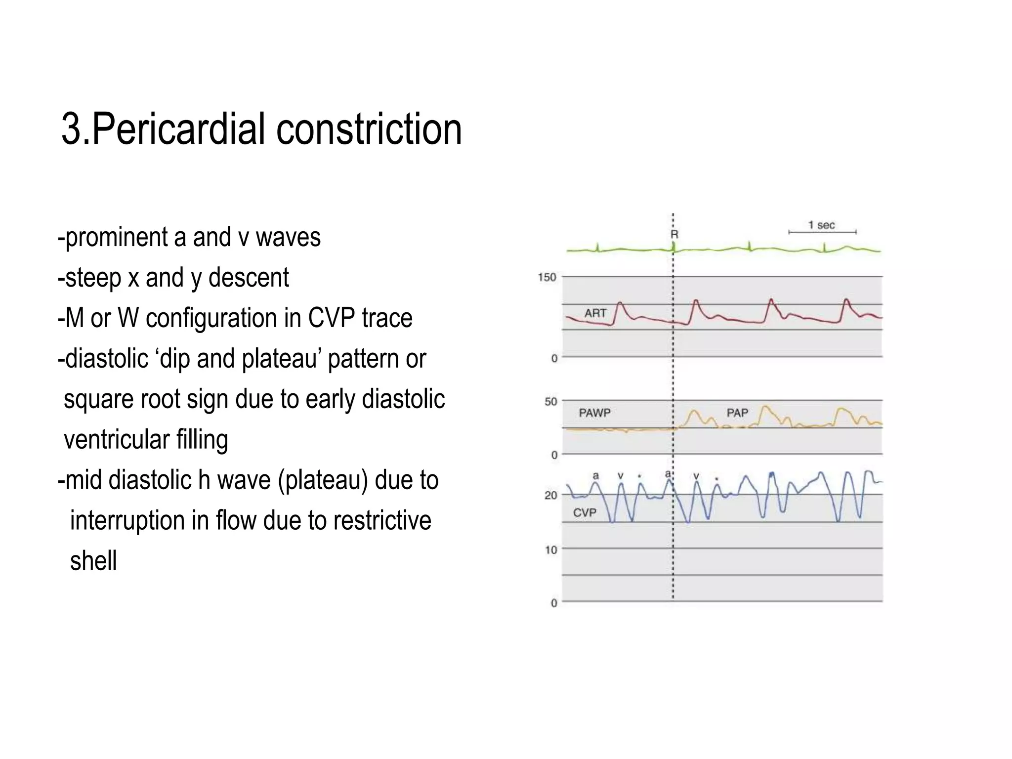 Pulmonary artery-catheter2 | PPTX